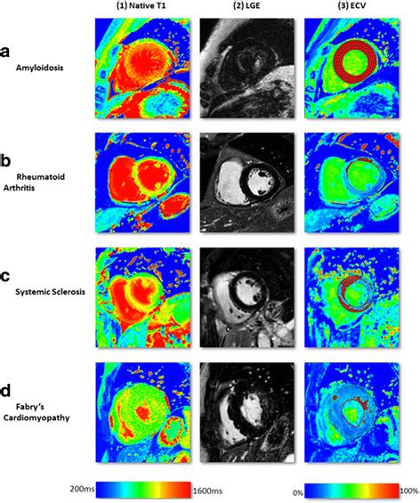Cardiac T1 Mapping And Extracellular Volume Ecv In Clinical Practice A Comprehensive Review