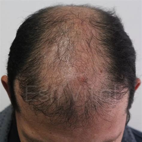 Caída De Cabello Esvital Center