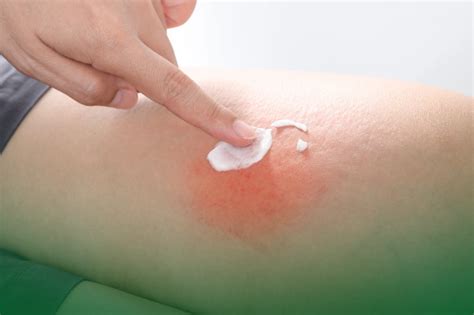 Cockroach Bite Treatment Guide How To Spot Treat And Prevent