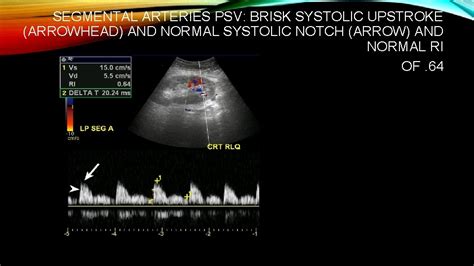 Ultrasound Evaluation Of The Renal Arteries And The