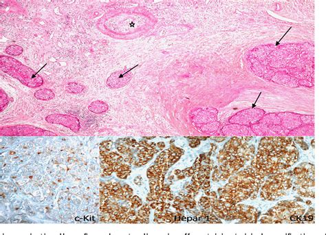 Figure 2 From Radiation Induced Cholangitis With Hepatocellular