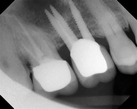 Zirconia Crown Radiograph