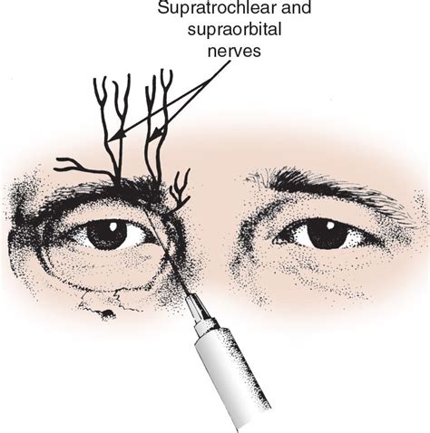 Facial Nerve Blocks Anesthesia Key
