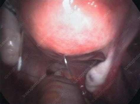 Removing A Displaced IUD Contraceptive Stock Image M Science Photo Library