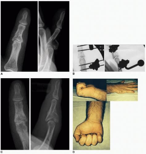 Operative Fixation Of Juxta Articular Intracapsular And Diaphyseal Fractures Of The Phalanges