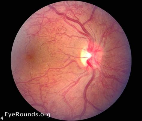 Atlas Entry Proliferative Diabetic Retinopathy Pdr