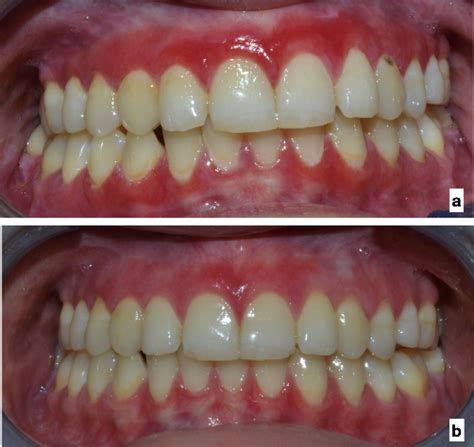 Oral Lichen Planus Gums
