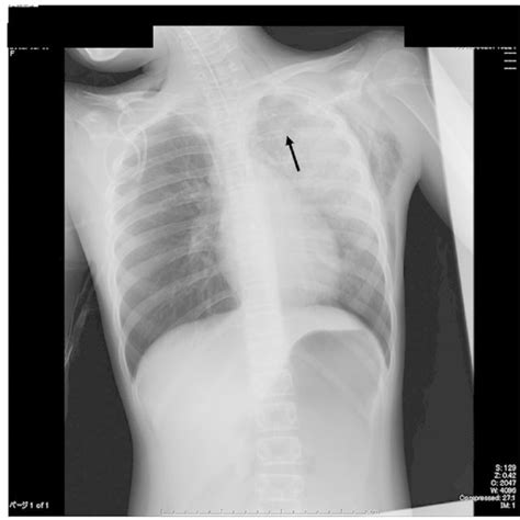 A Chest X Ray After Emergent Chest Decompression The Arrow Shows The