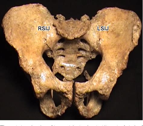 Figure 1 From Bilateral Ankylosis Of Sacro Iliac Joint With Ossified