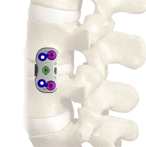 Product Detail Neurospine