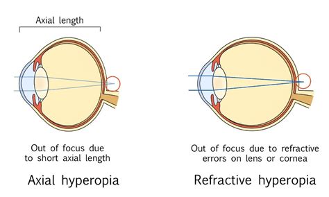 Hyperopia Hoya Corporation
