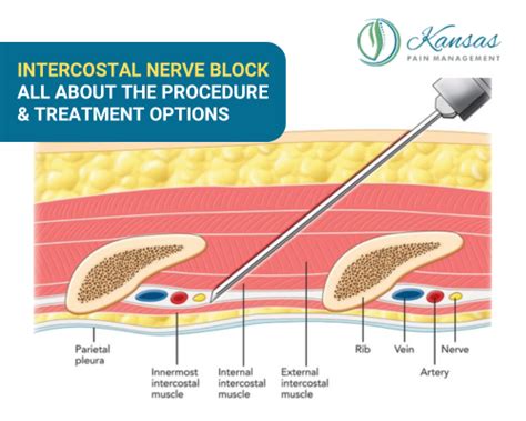 Intercostal Nerve Block Procedure And Treatment Options