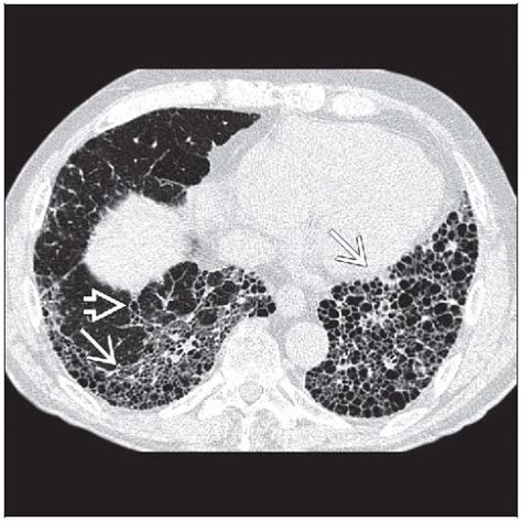 Idiopathic Pulmonary Fibrosis Radiology Key