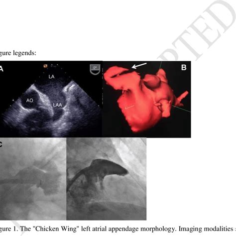 A Color Doppler Echocardiography Image Is Showing Residual Peridevice