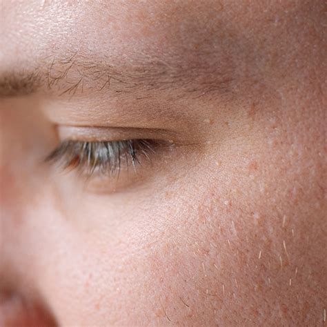 Genital Warts Spread To Face