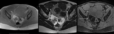 Mri Classification And Characterization Of Complex Ovarian Masses Applied Radiology