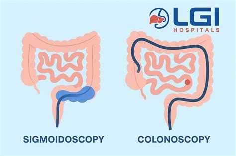 Sigmoidoscopy Vs Colonoscopy Key Differences And Guide