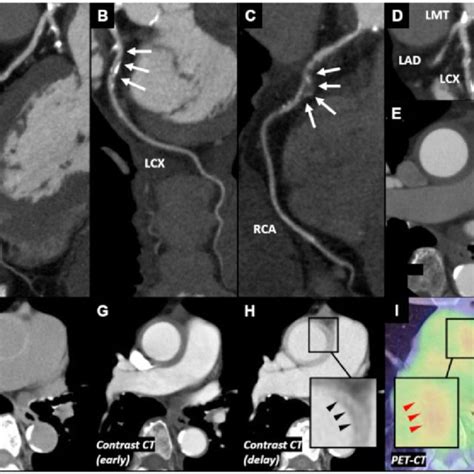 Computed Tomography Computed Tomography Angiography And Positron