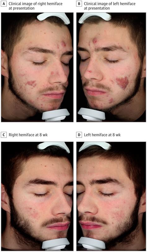 Acne Conglobata And Bimekizumab Melinda Gooderham