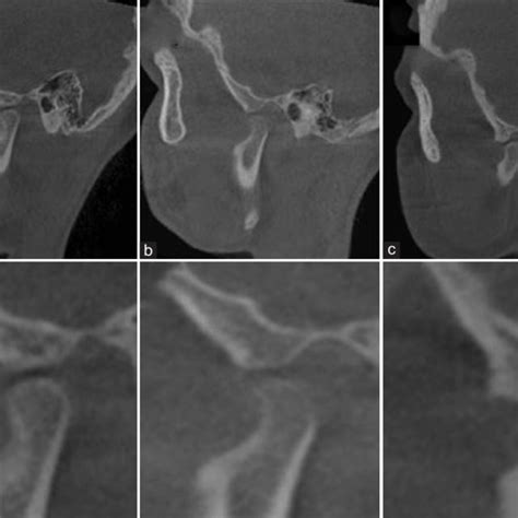 A And D Reveals The Sagittal Section Of The Condylar Region Showing