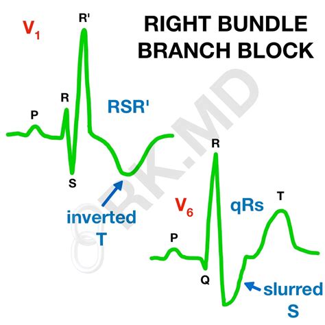 Rishi Kumar Md In Right Bundle Branch Block Rbbb The Facebook