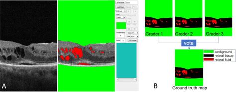 Automated Segmentation Of Retinal Fluid Volumes From Structural And Angiographic Optical