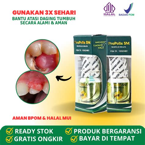 Medicine For Meat Growing In Perforated Teeth Removal Of Dental Polyp Pulp Gums Growing In