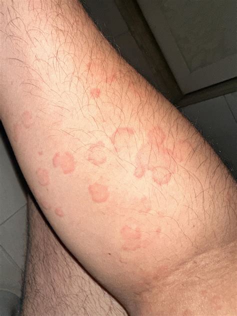 Red Bumpy Rash Having Outer Ring And Non Itchy And Having No Pain R