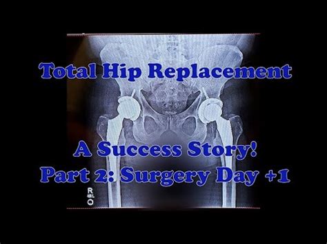 Part 2 Surgery Day 1 Hip Replacement 1 Year Success Story Youtube