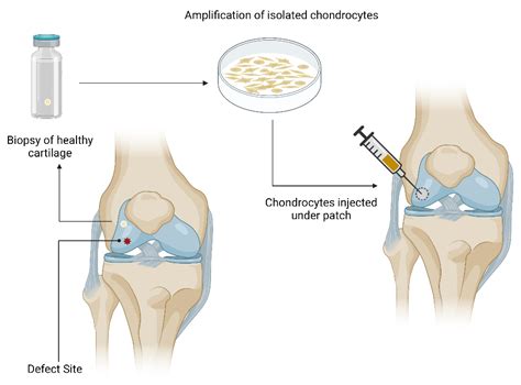 Chondrocyte De Differentiation Biophysical Cues To Nuclear Alterations
