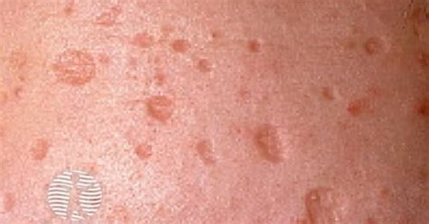 Chickenpox Scars S Image
