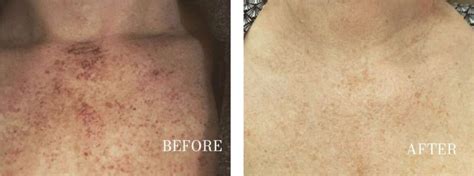 3 Ways To Treat Age Spots Total Wrapture Medi Spa