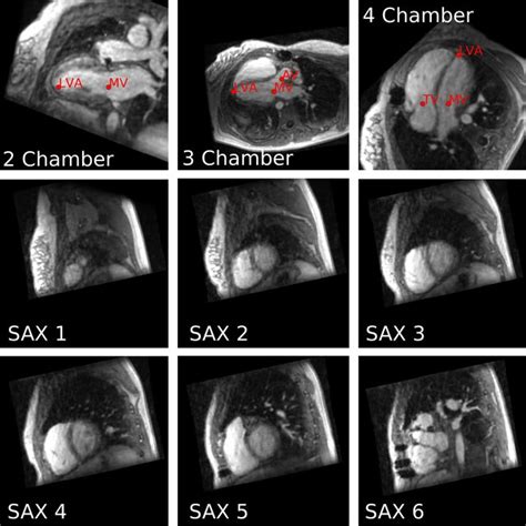 Cardiac Views Results For A 3d Cine Single Breath Hold Mri Left 4