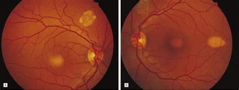 Normal Electro Oculogram In A Patient With Vitelliruptive Macular