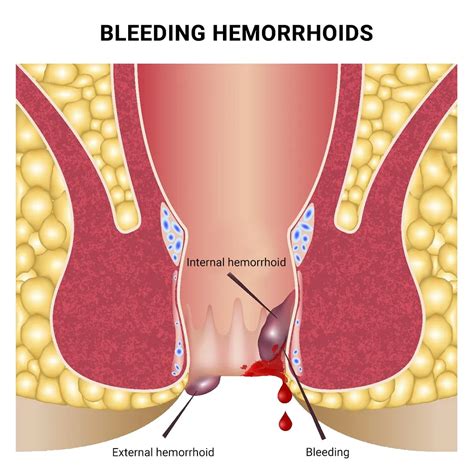 Top Signs And Symptoms Of A Thrombosed Hemorrhoid