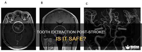 Tooth Extraction Post Stroke Is It Safe Medshun