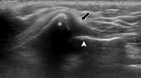 Imaging Of The Acromioclavicular Joint Anatomy Function Pathologic Features And