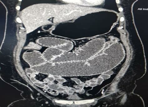 Dilated Proximal Bowel Download Scientific Diagram
