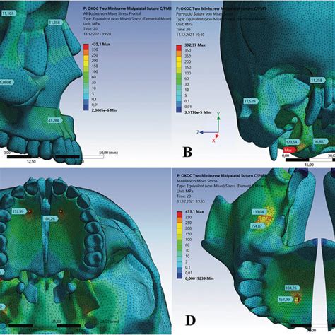 A And C Model I Unilateral Stress Distribution In The Craniofacial
