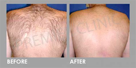 Laser Treatment For Acne And Hair Removal Premier Clinic