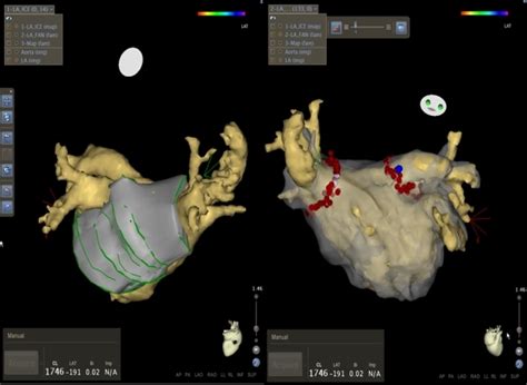 Use Of Intracardiac Echocardiogram To Facilitate Image Integration By Download Scientific