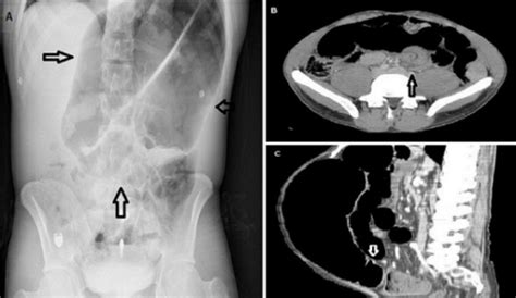 Volvulus Concise Medical Knowledge