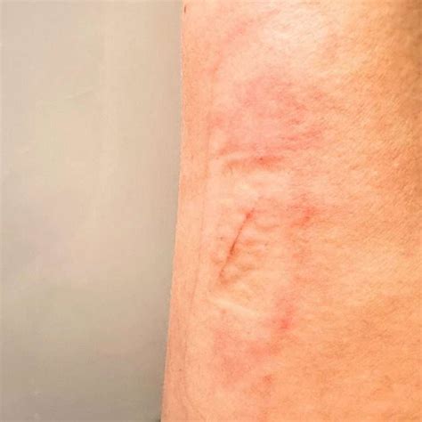 How To Manage Allergy To Adhesive Bandages And Tapes Allergy Spot