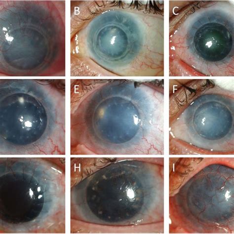 Overall Success In Ocular Surface Reconstruction Using Different Stem