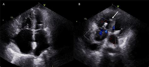 Successful Implantation Of A Leadless Pacemaker In A Patient With A