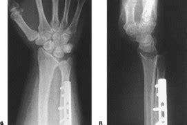 Treatment Of Madelungs Deformity In Adults By Ulna Reduction Osteotomy