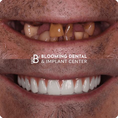 Permanent Teeth Solutions In Jacksonville Jacksonville Implant Clinic