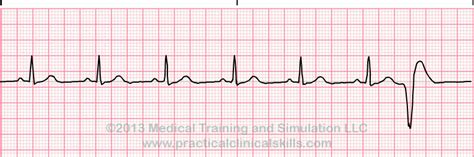 Ventricular Rhythms