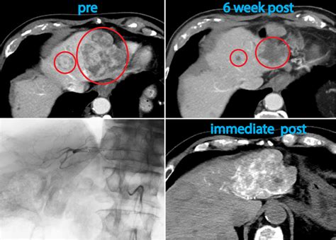 Transarterial Embolization Of Liver Metastases Using Pedd Left A Download Scientific Diagram