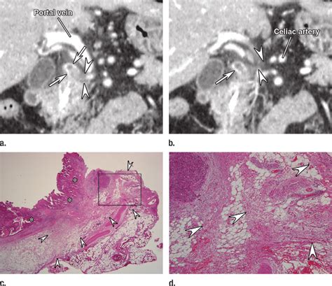 False Positive Imaging Diagnosis Of Posterior Hepatic Plexus 1 Invasion